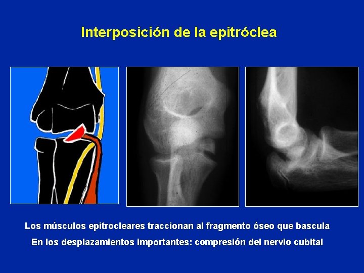 Luxaciones del Codo Relaciones del nervio cubital Luxacin