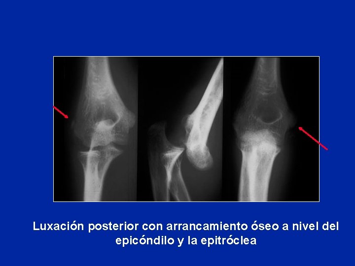Luxaciones del Codo Relaciones del nervio cubital Luxacin