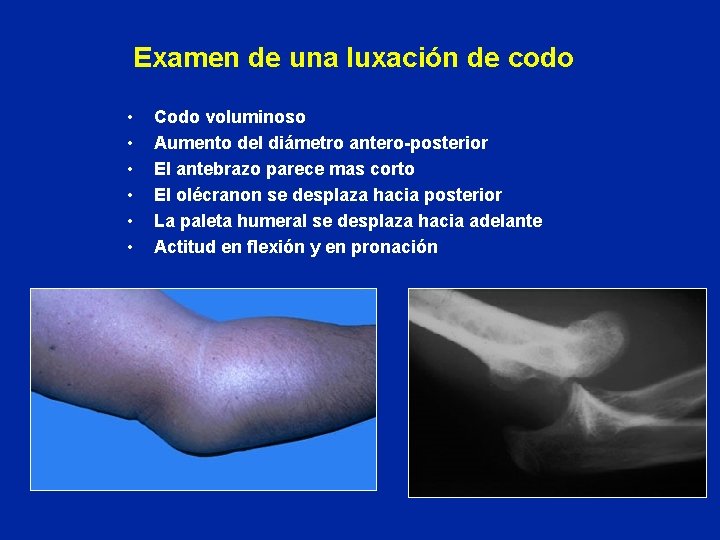 Luxaciones del Codo Relaciones del nervio cubital Luxacin