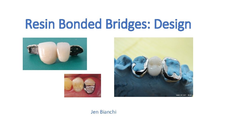 Resin Bonded Bridges Design Jen Bianchi Aims Objectives