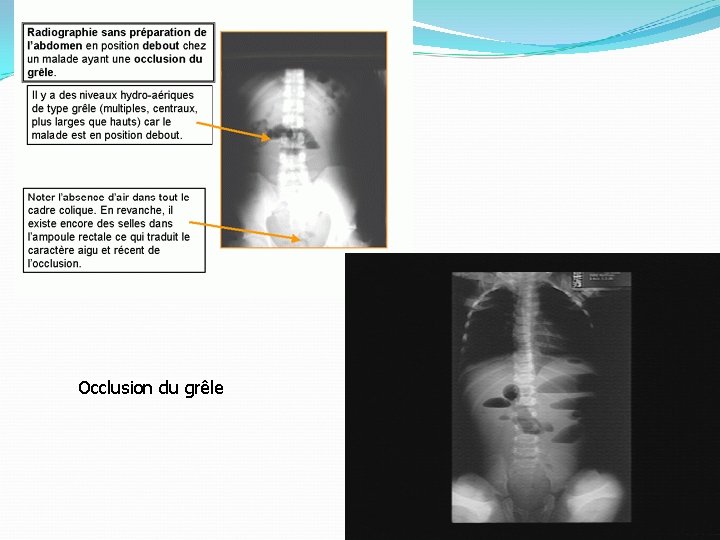 OCCLUSION DU GRLE OCCLUSION DU COLON Dfinition Le
