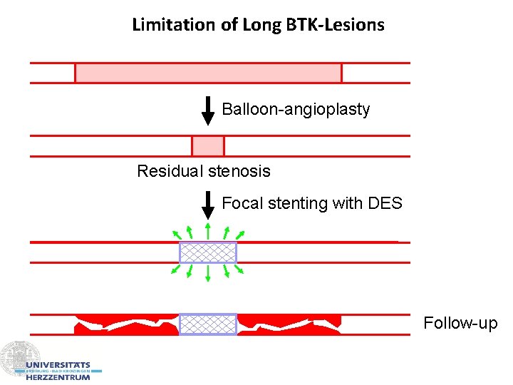 Role of Stenting in BTK Intervention Thomas Zeller