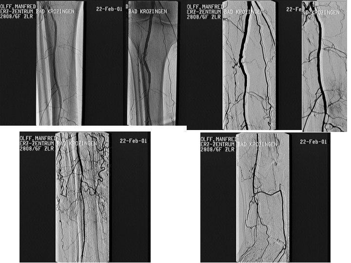 Role of Stenting in BTK Intervention Thomas Zeller