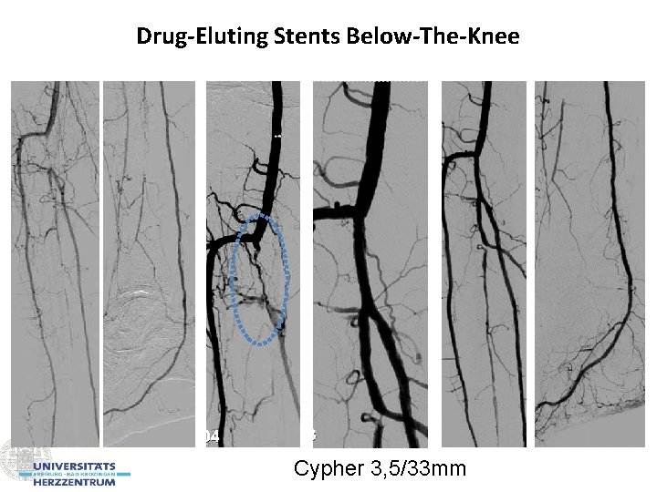 Role of Stenting in BTK Intervention Thomas Zeller