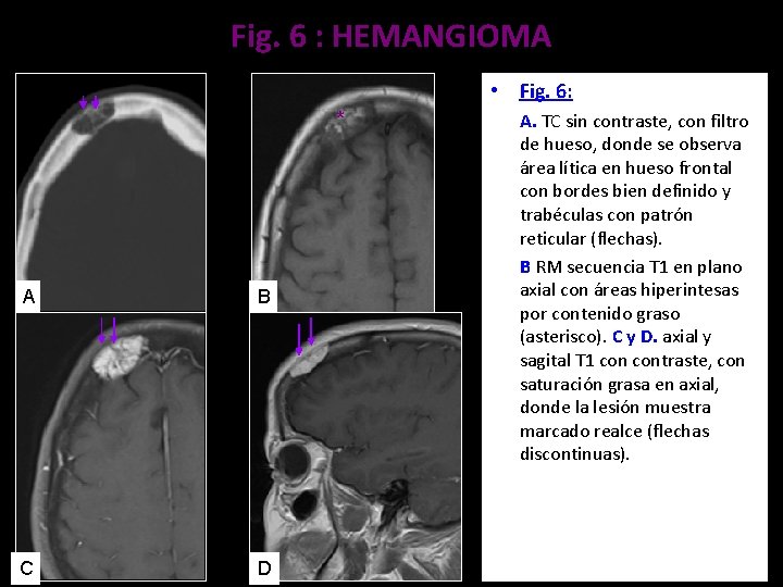 CARACTERIZACIN Y DIAGNSTICO DIFERENCIAL MEDIANTE TCMD Y RM