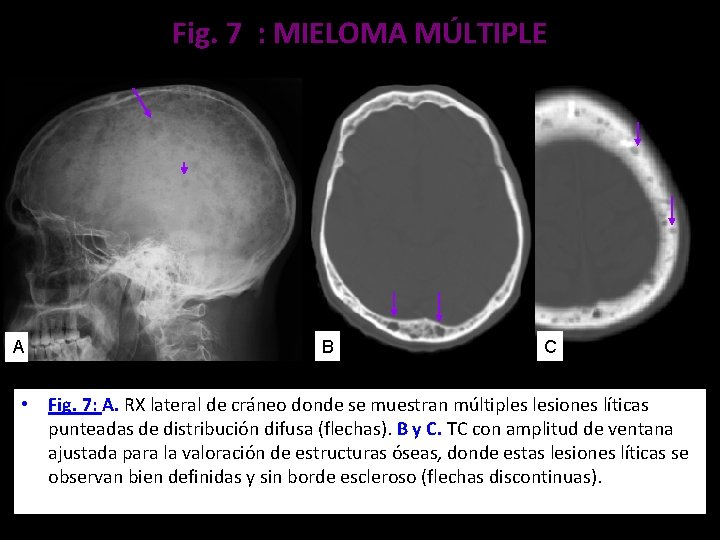 CARACTERIZACIN Y DIAGNSTICO DIFERENCIAL MEDIANTE TCMD Y RM