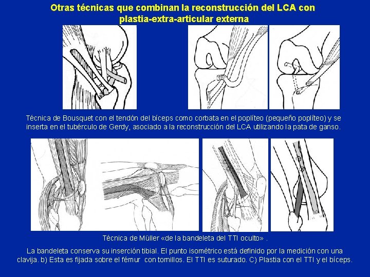 Ligamentos de la Rodilla En flexin las fibras