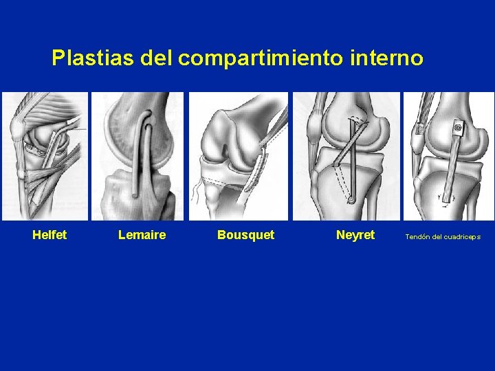 Ligamentos de la Rodilla En flexin las fibras
