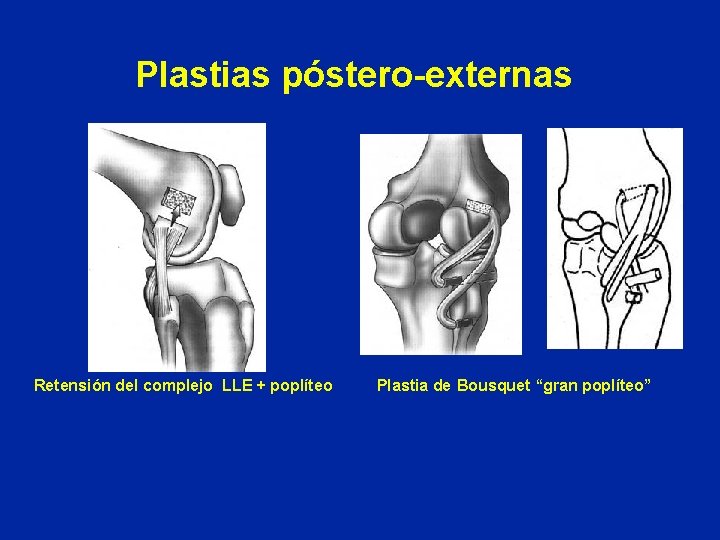 Ligamentos de la Rodilla En flexin las fibras