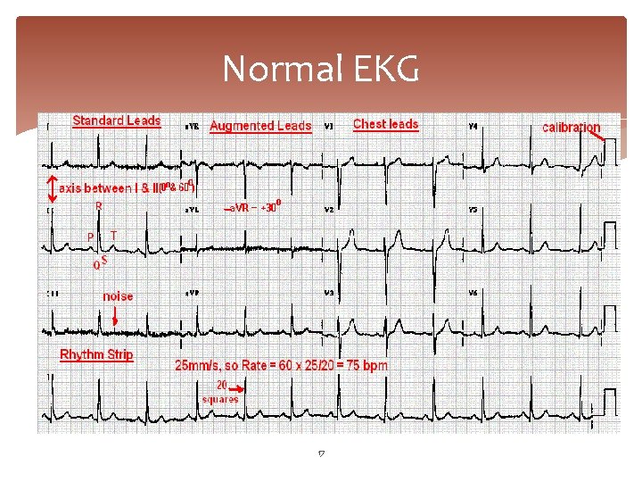 Decreased Cardiac Output Medical Surgical Nursing II Spring