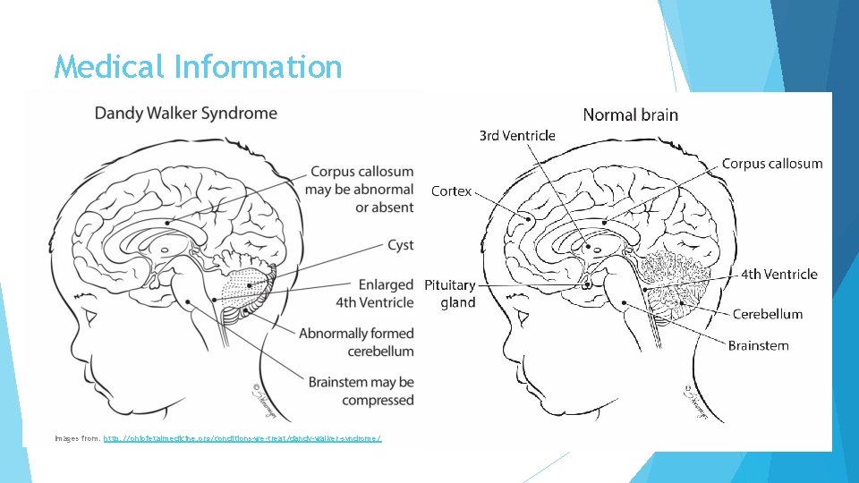 DandyWalker Syndrome By Amanda Mc Murter What is