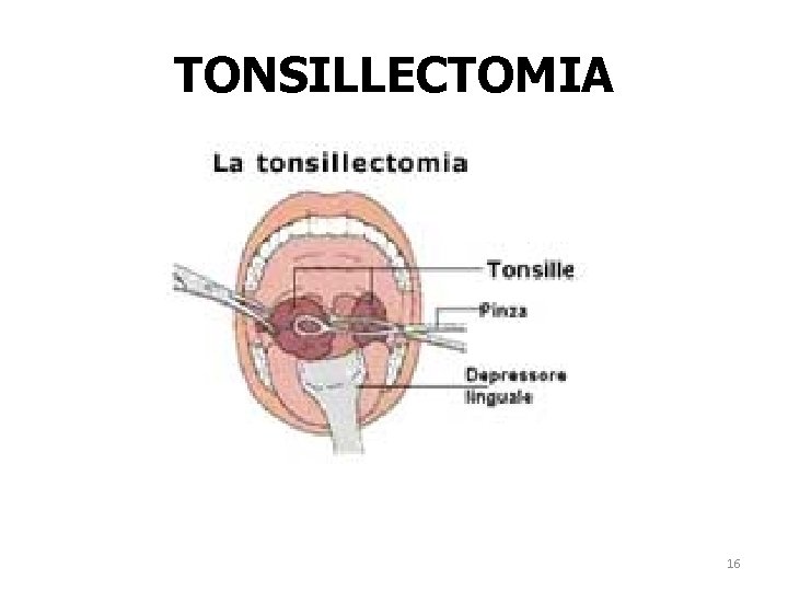TONSILLECTOMIA ASSISTENZA PRE E POST OPERATORIA AL PAZIENTE