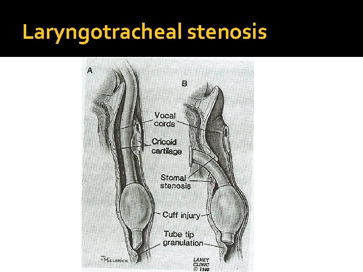 Open reconstruction of Airway Stenosis Laryngotracheal Stenosis Etiology