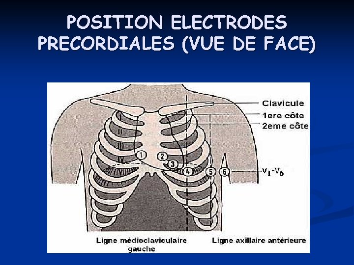 TROUBLES DU RYTHME ET DE LA CONDUCTION ECG