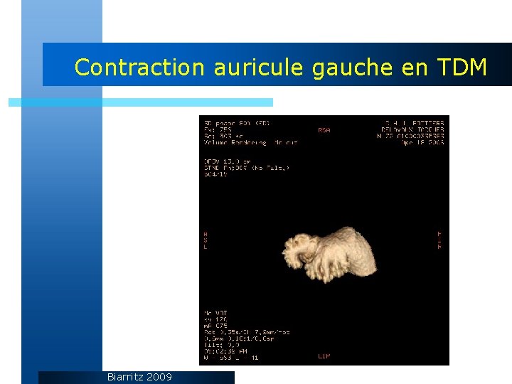 Imagerie de loreillette gauche Dr L Christiaens Cardiologie