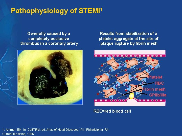 Clopidogrel in Patients with STSegment Elevation Myocardial Infarction