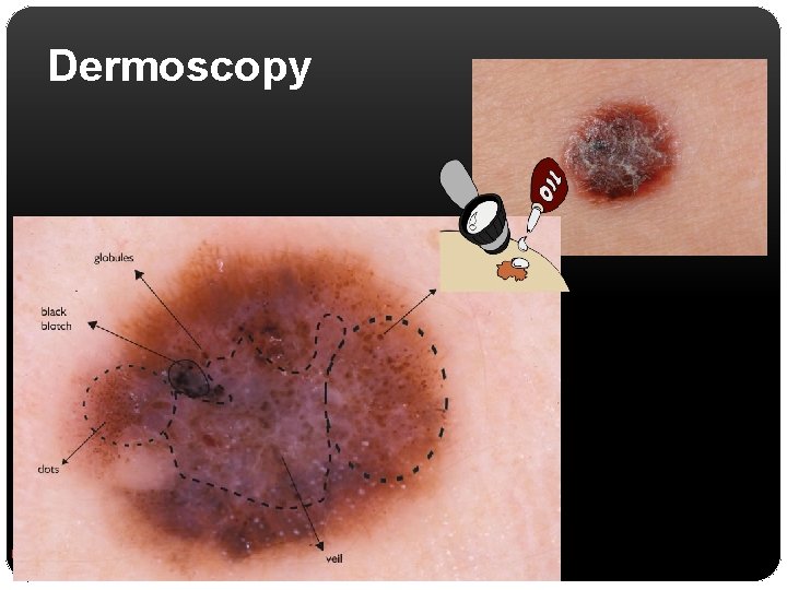 SPIE Medical Imaging 2010 Graphbased Pigment Network Detection