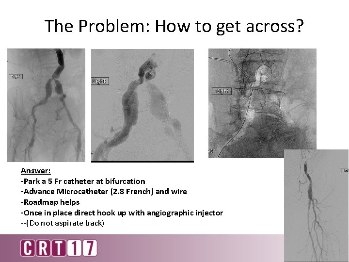 Novel Use Of Microcatheters Techniques To Perform Angiography