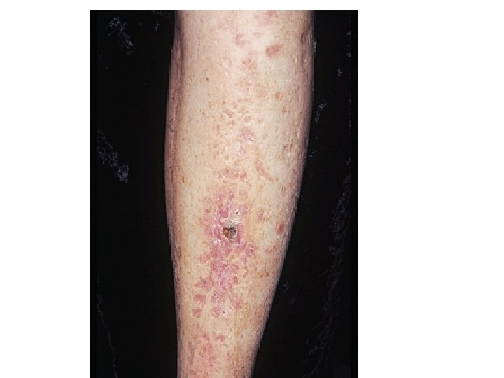 Skin Disorders of Diabetes Mellitus Pongsakorn Thitachote MD