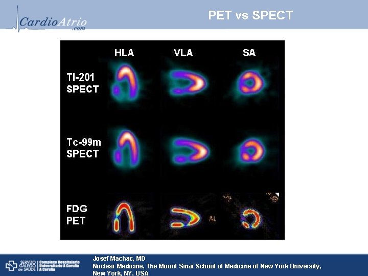 DIAGNOSTICANDO LA CARDIOPATA ISQUMICA DESDE EL ECG HASTA