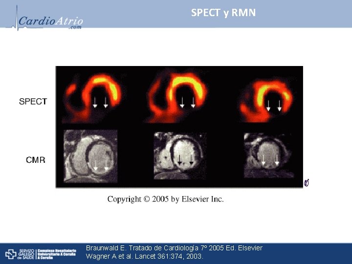 DIAGNOSTICANDO LA CARDIOPATA ISQUMICA DESDE EL ECG HASTA