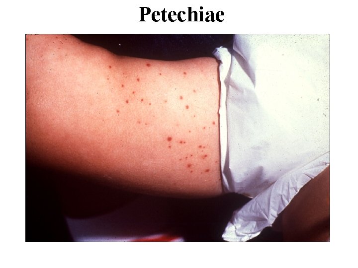 ADVANCES IN THE DIAGNOSIS AND TREATMENT OF THROMBOCYTOPENIA