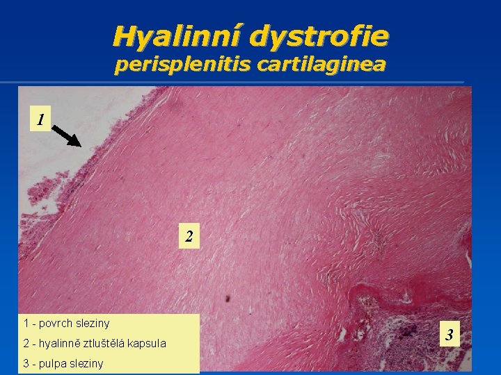 Michal Tich DYSTROFIE DIABETES PIGMENTY PNEUMOKONIZY INTRACELULRN AKUMULACE