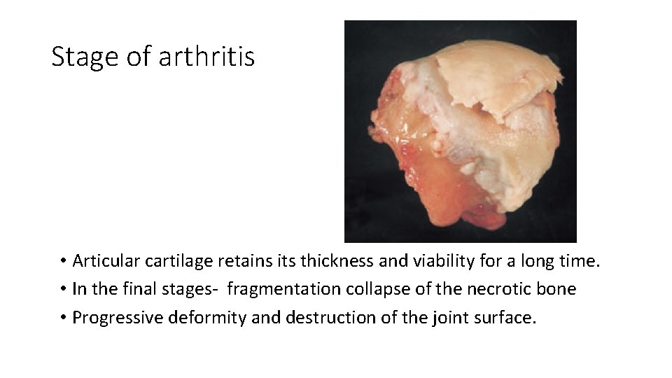 Avascular Necrosis Dr R B Kalia Additional Professor