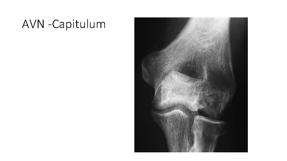 Avascular Necrosis Dr R B Kalia Additional Professor