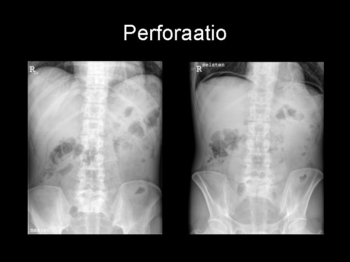 RO 7 TKradiologian perusteet Natiivikuvat Petri Sipola LT