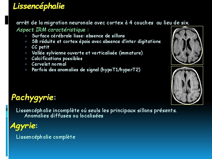 Les malformations crbrales Dr Ajbal Pr Basraoui Plan