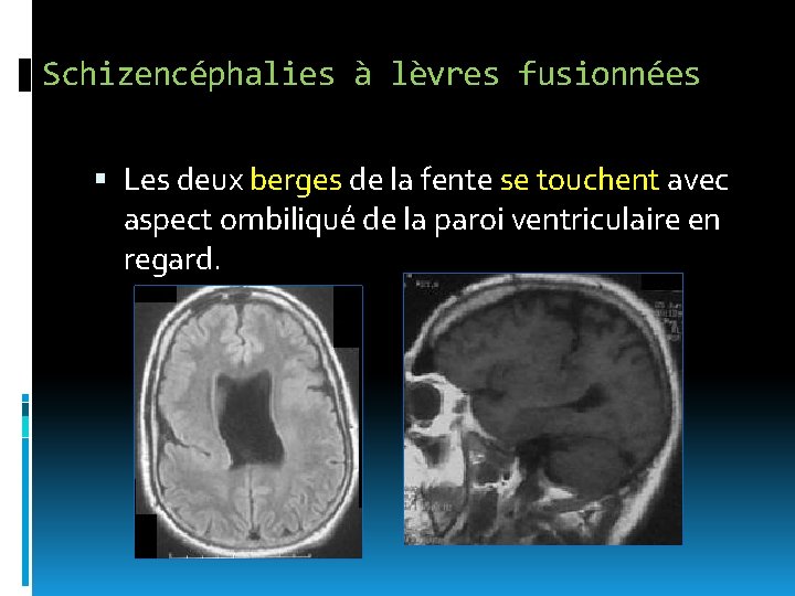 Les malformations crbrales Dr Ajbal Pr Basraoui Plan