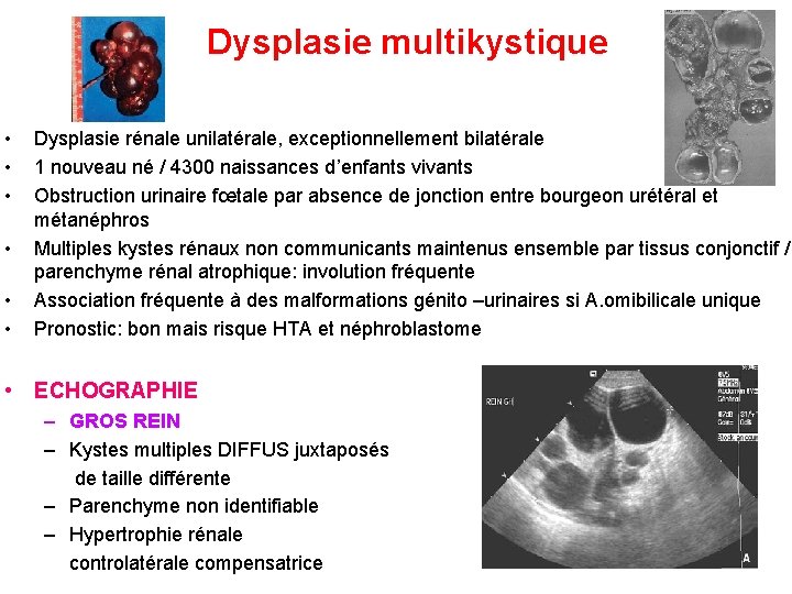 MALADIES KYSTIQUES RENALES Marine VanTriempont et Mlanie Hanoy