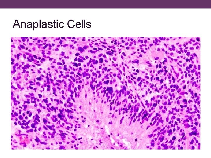 UNDERSTANDING AND EXPLOITING THE TUMOR MICROENVIRONMENT IN GLIOBLASTOMA