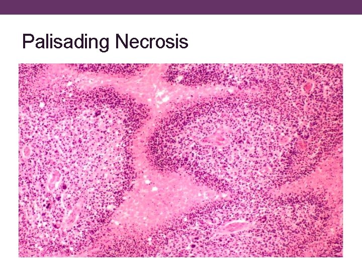 UNDERSTANDING AND EXPLOITING THE TUMOR MICROENVIRONMENT IN GLIOBLASTOMA