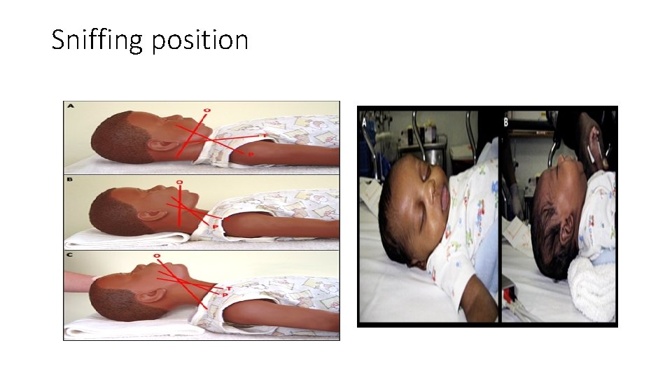 Basic Airway Management Dr Nishith Govil Associate Professor