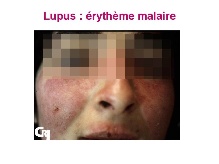 AUTOIMMUNITE ET MALADIES AUTOIMMUNES Pr H FELLAH Laboratoire