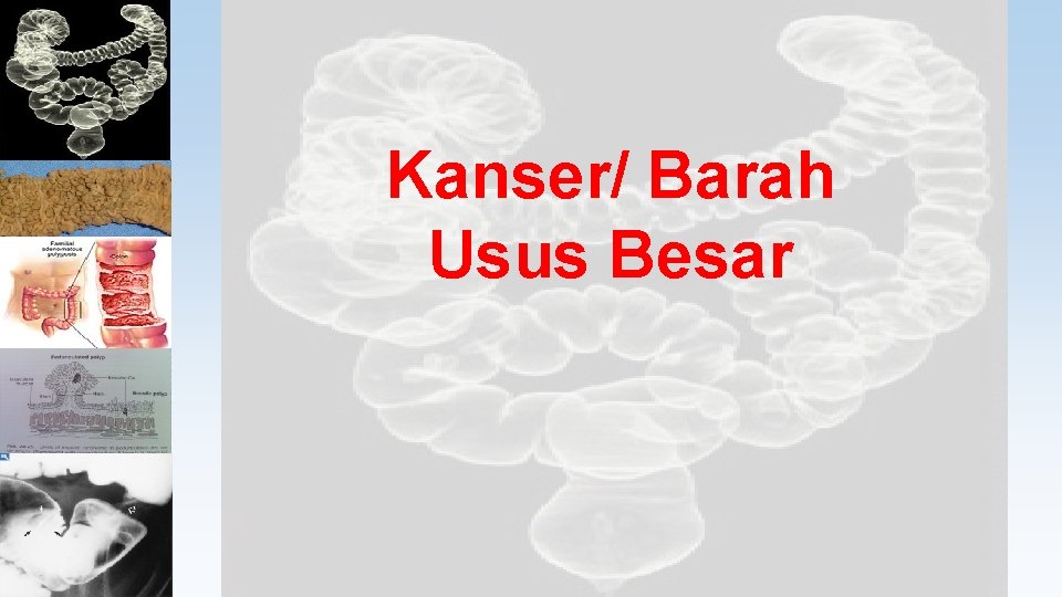 Kanser Barah Usus Besar Apa itu kanser Selsel