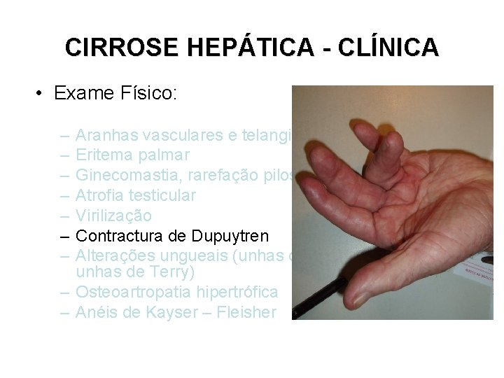 CIRROSE HEPTICA CIRROSE HEPTICA ETIOLOGIA Causas mais frequentes