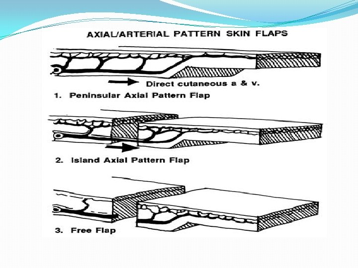GRAFTS AND FLAPS BY Dr Mahmoud Abdalla Hifny
