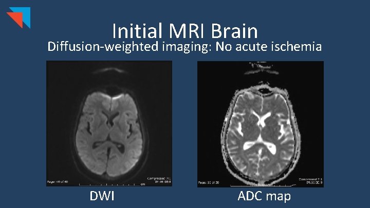 Diagnostic Challenge in a Case of Bing Neel