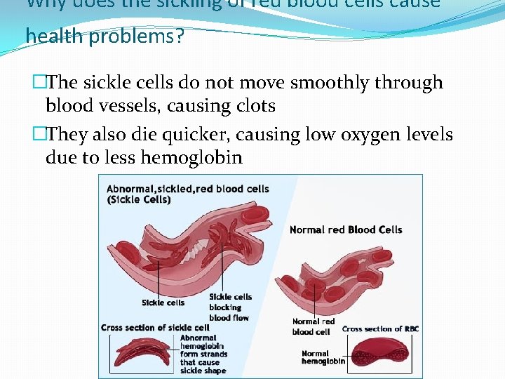 3 1 Review PBS What is sickle cell