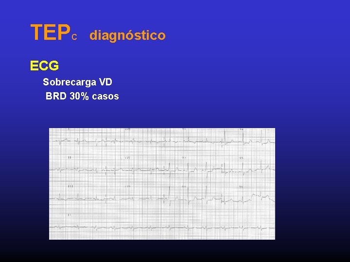 TROMBOEMBOLISMO PULMONAR CRNICO UNIFESP Carlos A Teles TEP