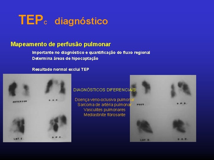 TROMBOEMBOLISMO PULMONAR CRNICO UNIFESP Carlos A Teles TEP