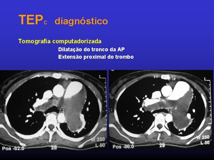 TROMBOEMBOLISMO PULMONAR CRNICO UNIFESP Carlos A Teles TEP