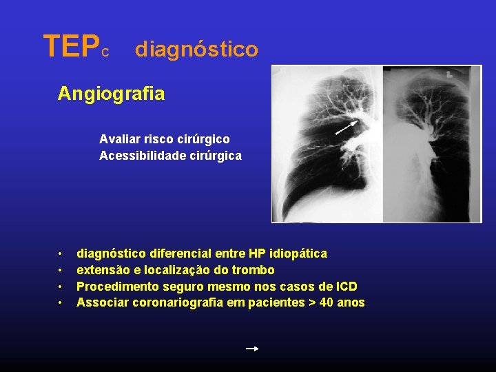 TROMBOEMBOLISMO PULMONAR CRNICO UNIFESP Carlos A Teles TEP