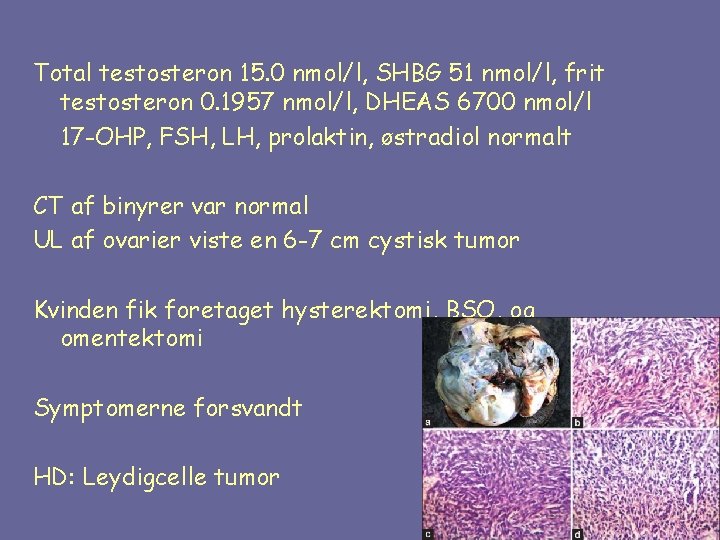 Udredning af hyperandrogenisme PCOS Pernille Ravn Overlge dr