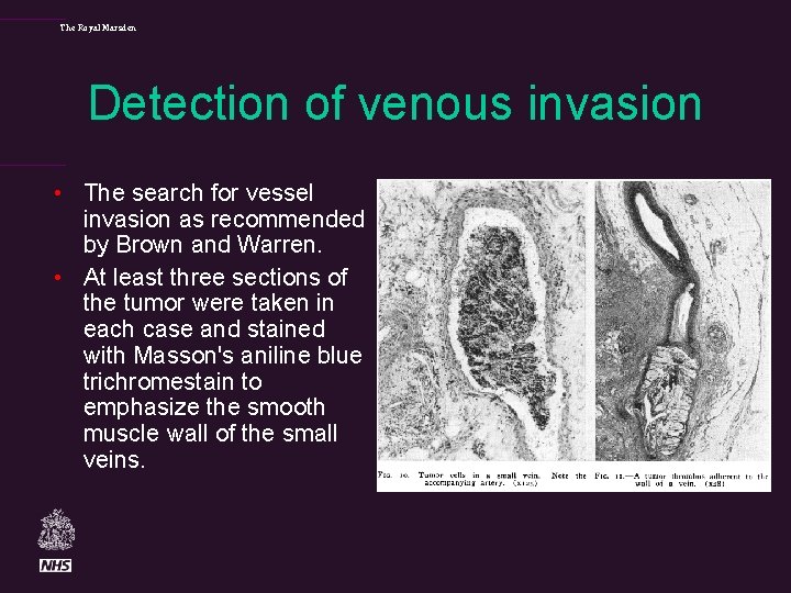 The Royal Marsden Extramural venous invasion in rectal