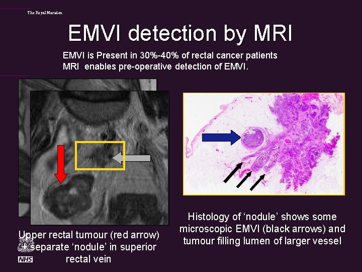 The Royal Marsden Extramural venous invasion in rectal