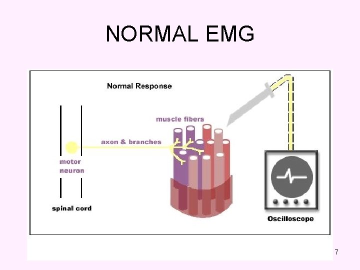 ELECTROMYOGRAPHY AND MOTOR NERVE CONDUCTION VELOCITY ELECTROMYOGRAPHY EMG